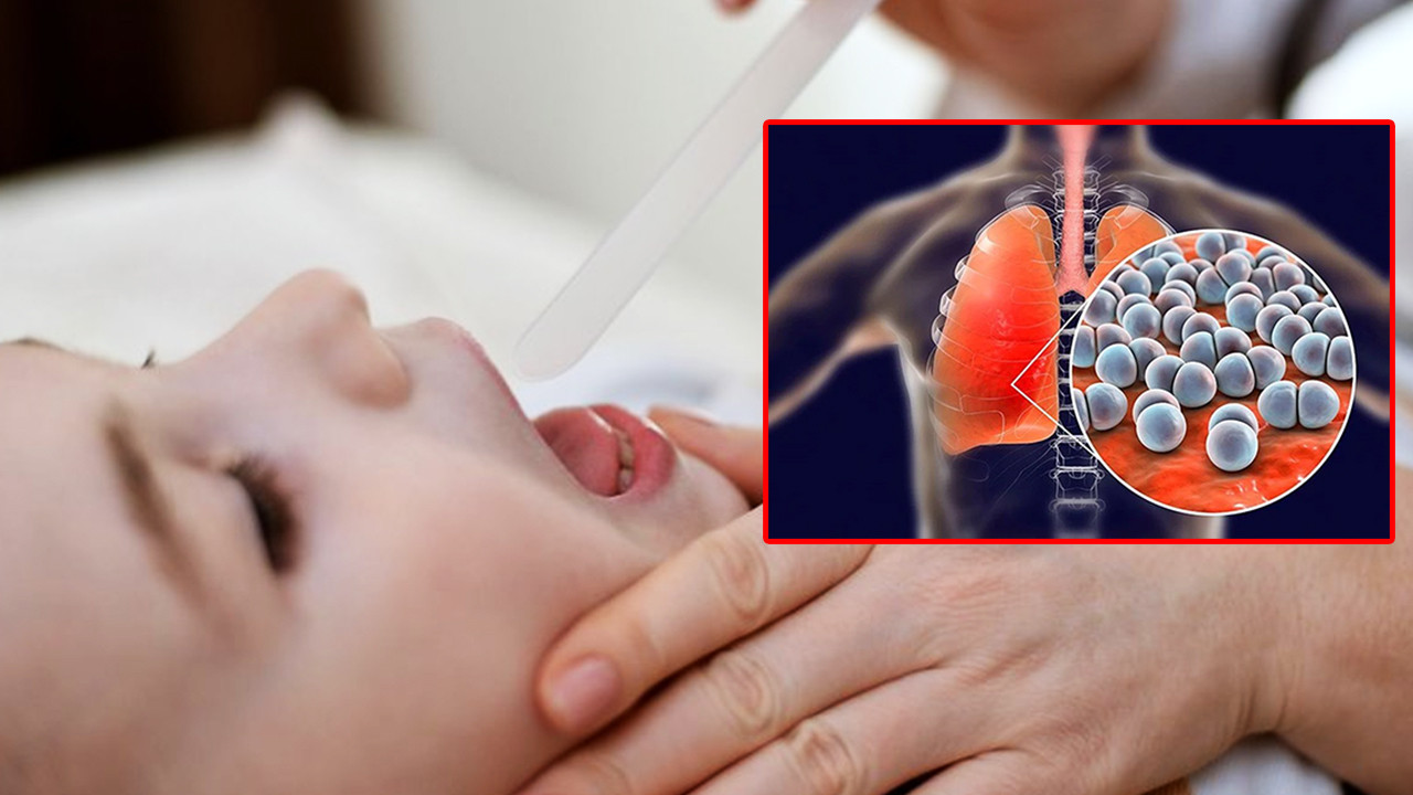 Strep A tam anlamıyla nedir, nasıl bulaşır? Strep A belirtileri, teşhis ...
